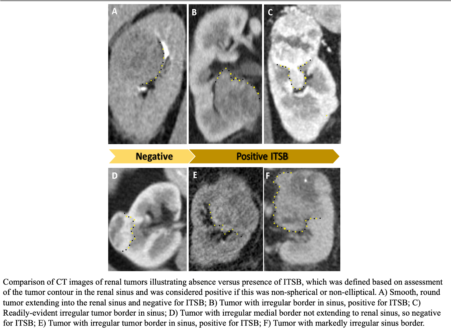 PD10-06: Radiologic Correlates of pT3a Kidney Cancer: Importance of ...